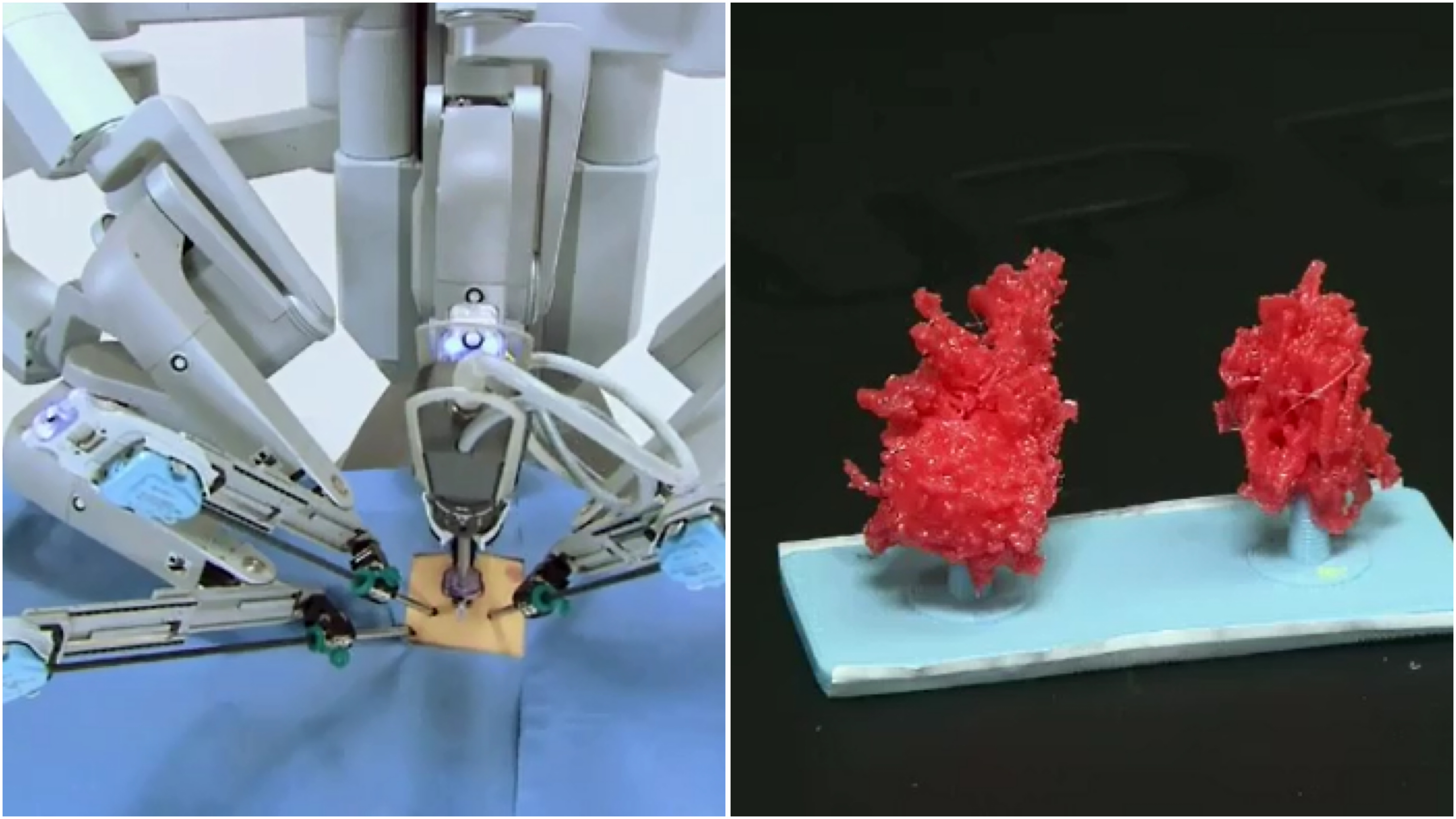 Chris O’Brien Lifehouse: da Vinci robotic surgery performed on breast ...