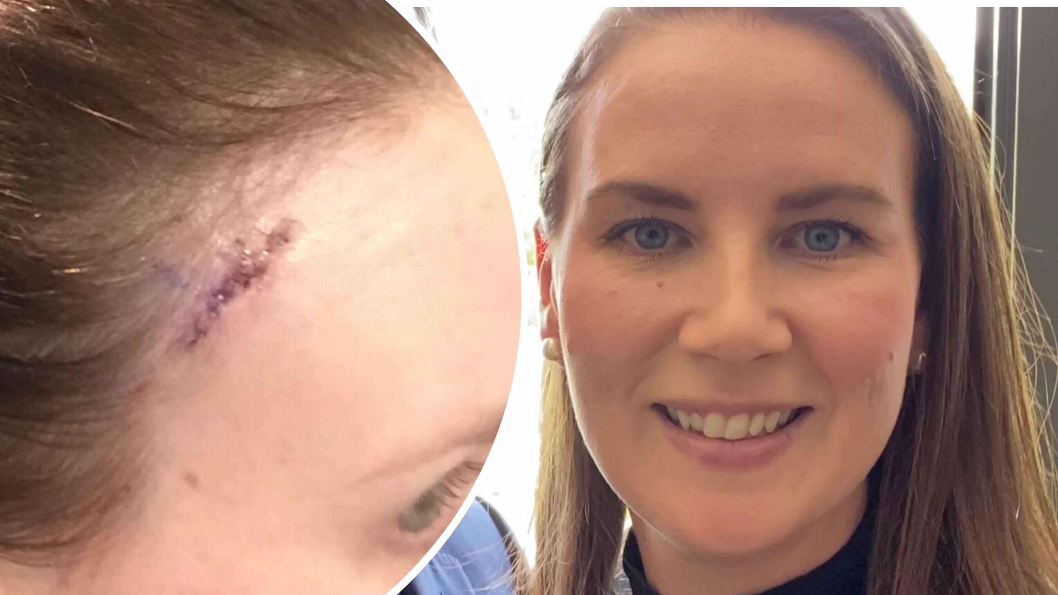 Tiny spot found on Sara's forehead kills 700 Aussies each year - NetFM