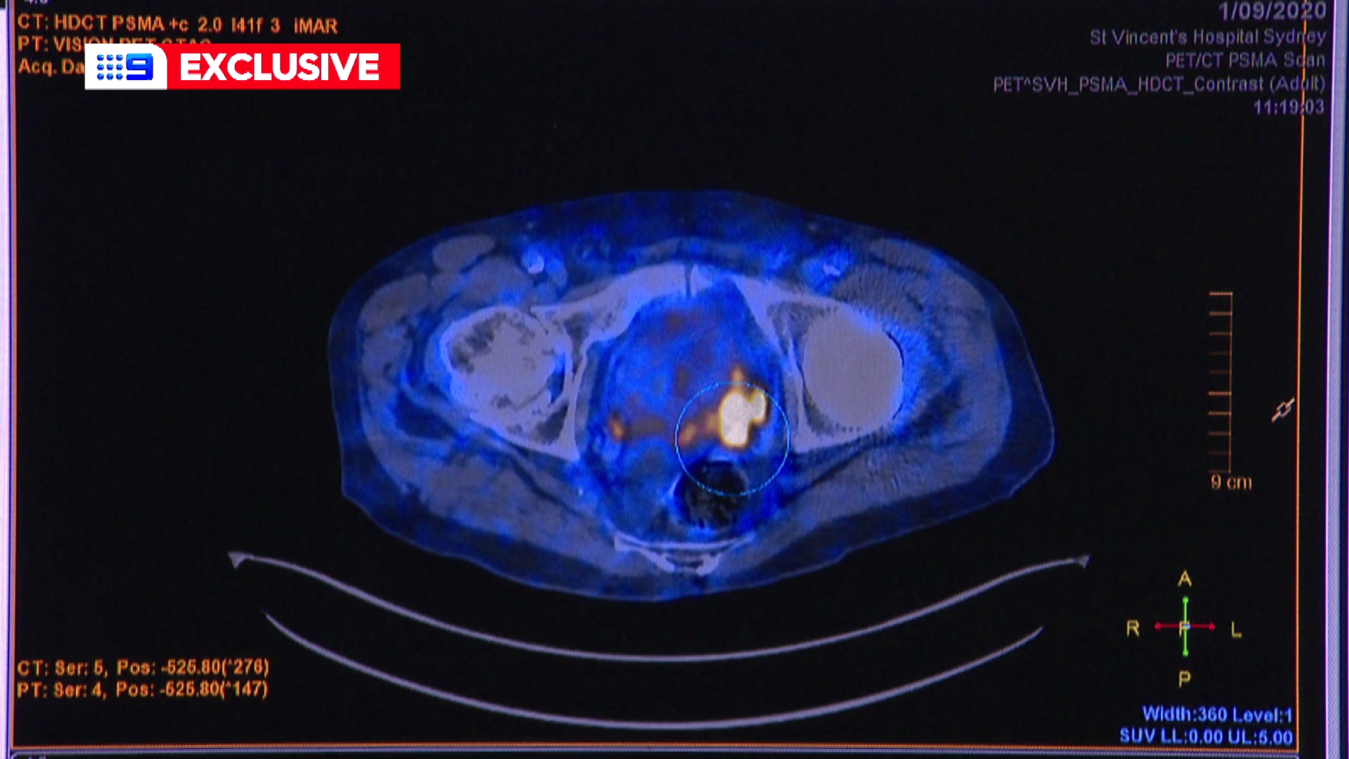 Prostate Cancer Treatment Worth 40000 A Year To Be On Pbs Flipboard
