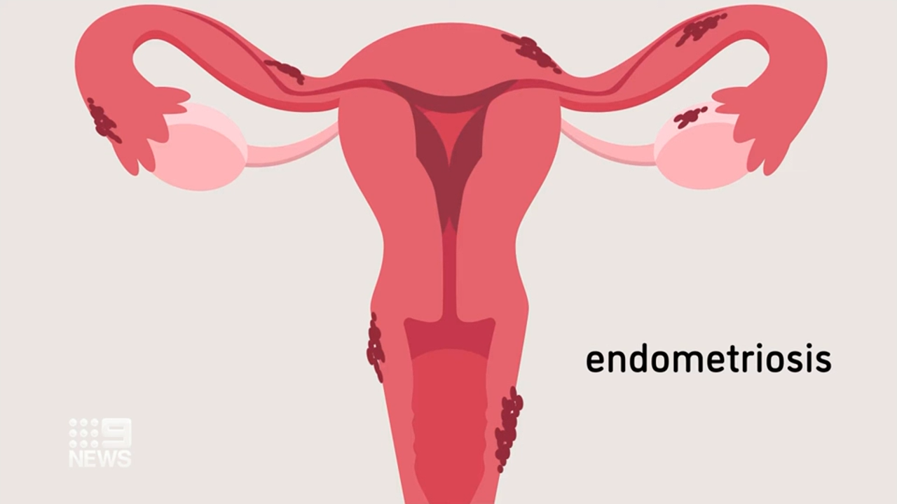 Women with endometriosis at greater risk of ovarian cancer – Mingooland